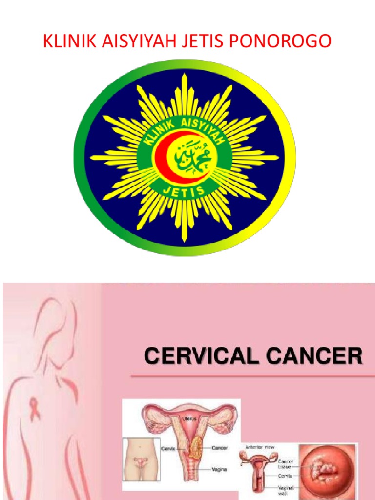 Ca Cervix | PDF