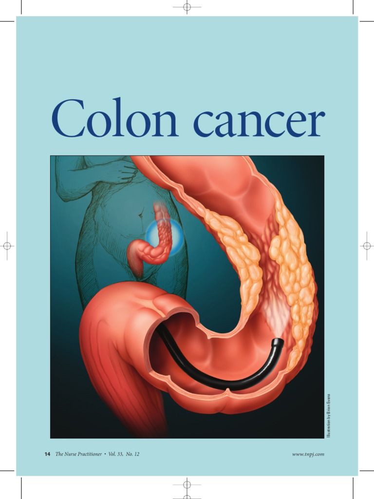 Colon Cancer | PDF | Colorectal Cancer | Colonoscopy