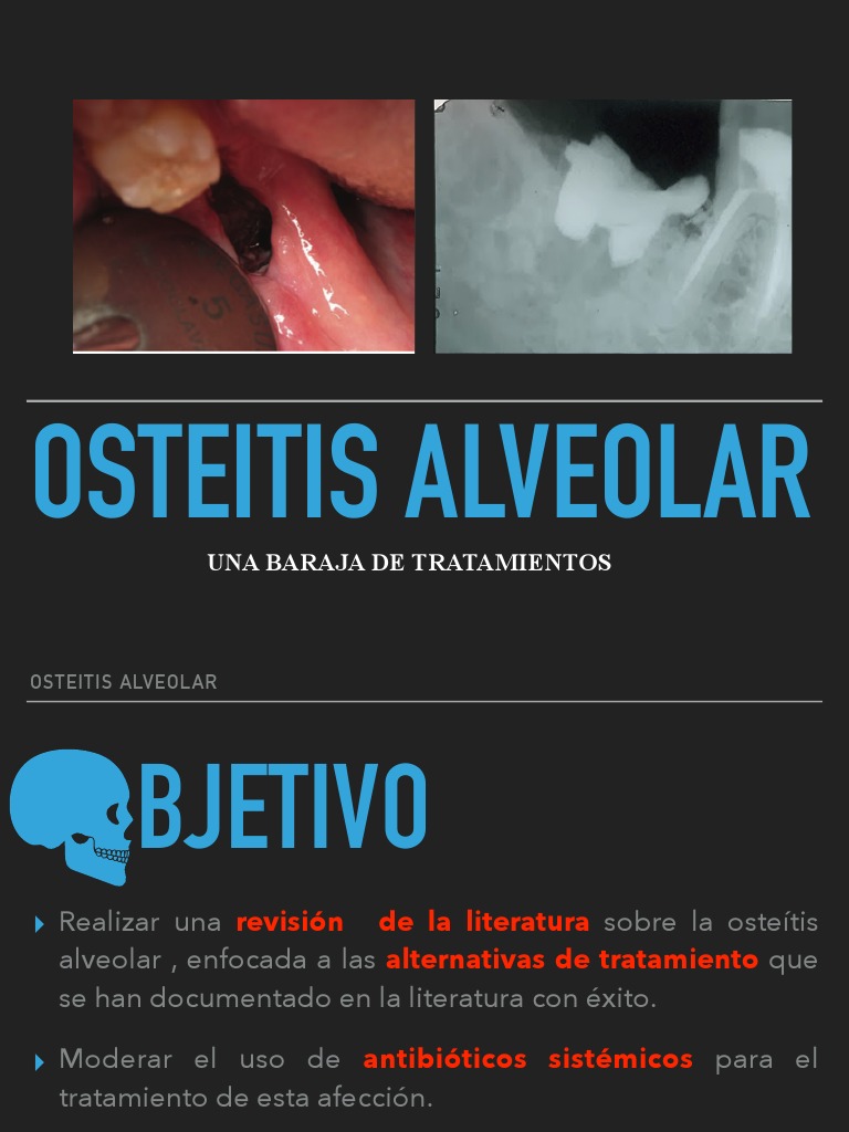 OSTEITIS ALVEOLAR - Alveolitis | PDF | Coagulación | Medicamentos con receta