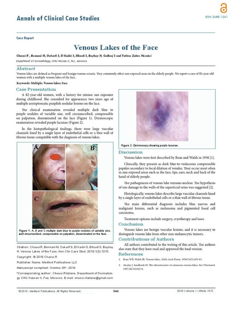 Venous Lakes of The Face 253 | Download Free PDF | Benign Tumor | Vein