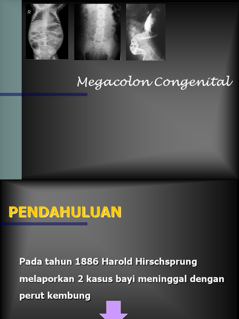 Megacolon Kongenital | PDF