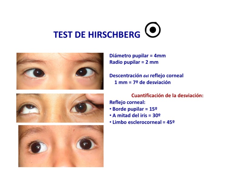 Test de Hirschberg | PDF
