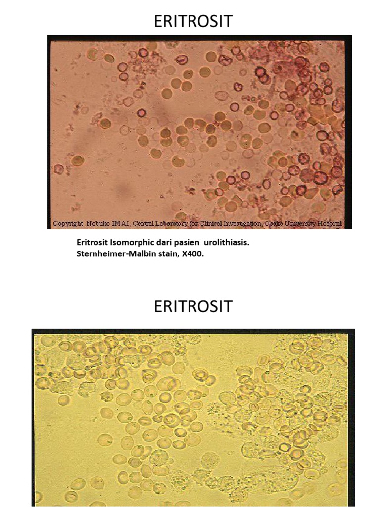 Analisis Eritrosit dan Leukosit Urine | PDF