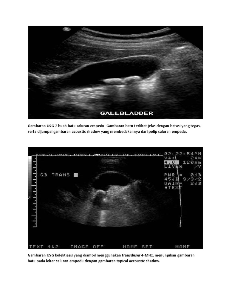 USG Cholelithiasis | PDF