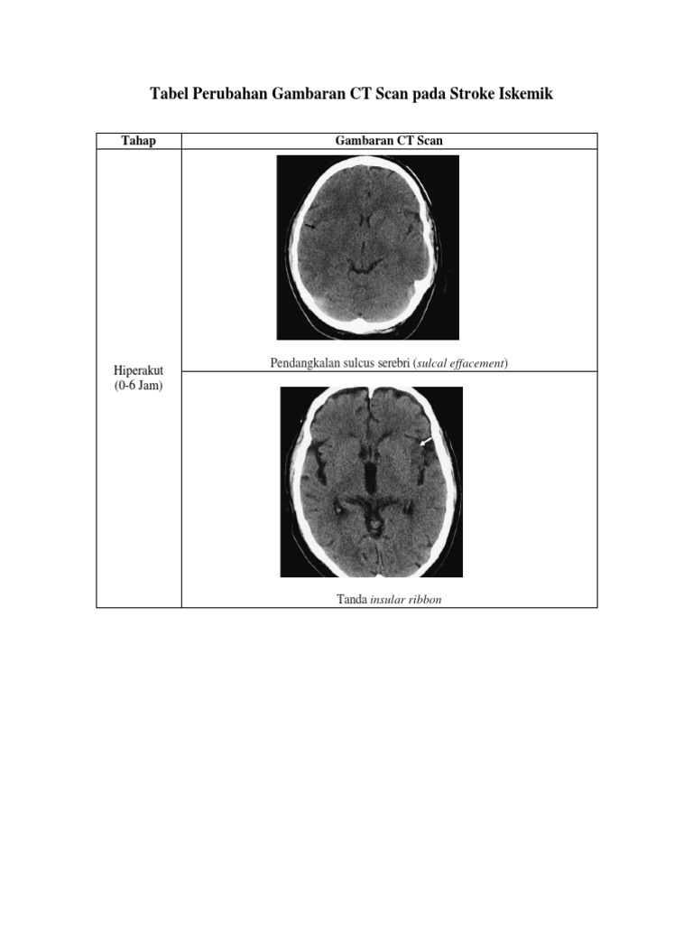 Perkembangan Gambaran CT Scan dan MRI pada Stroke Iskemik | PDF