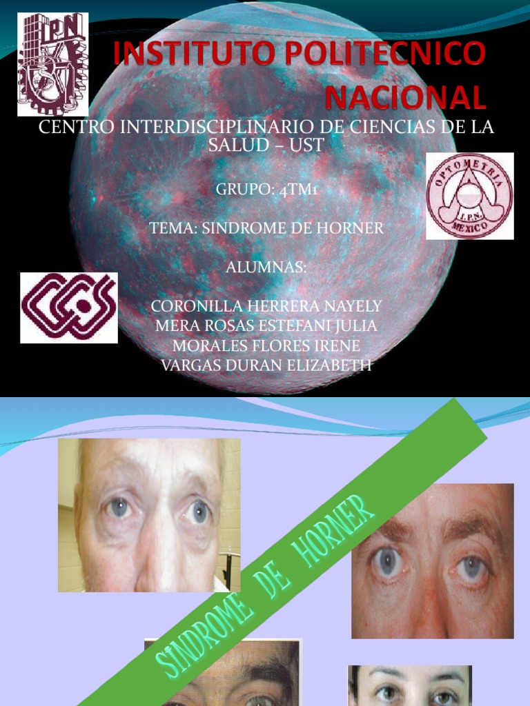 Sindrome de Horner | PDF | Enfermedades y trastornos | Sistema nervioso