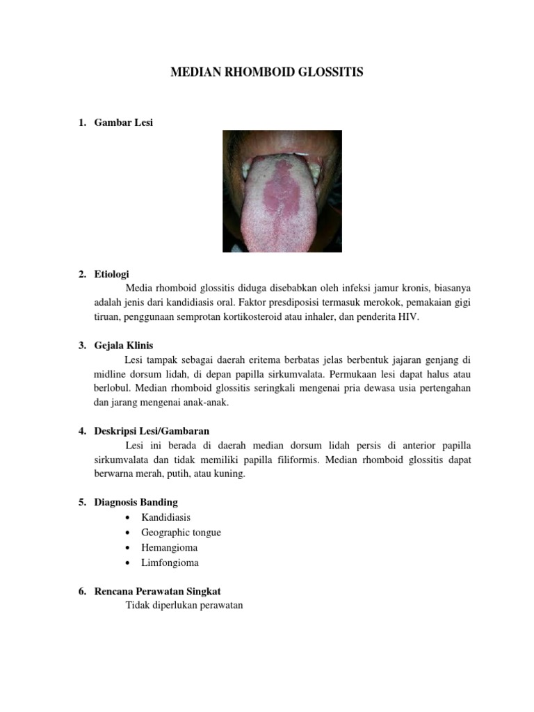 Median Rhomboid Glossitis | PDF