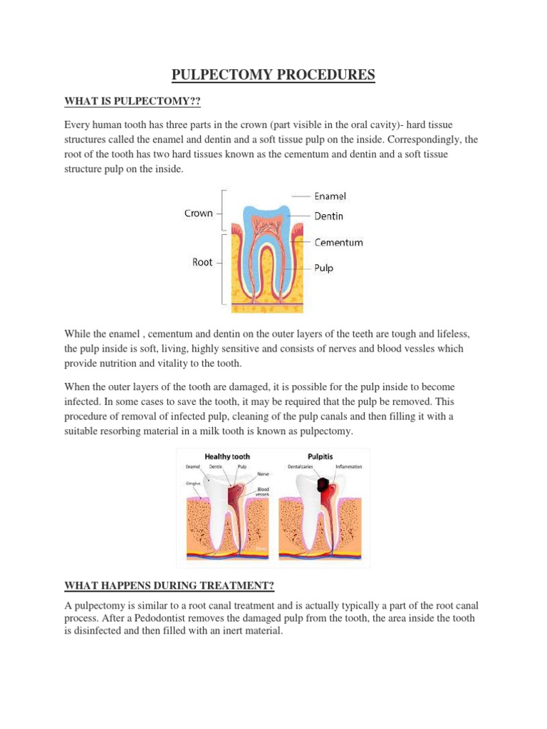 Pulpectomy Procedures | PDF | Human Tooth | Tooth