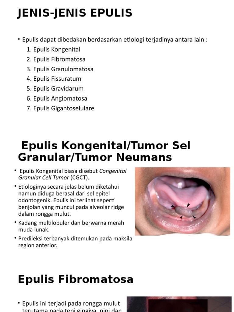 Epulis Granulomatosa