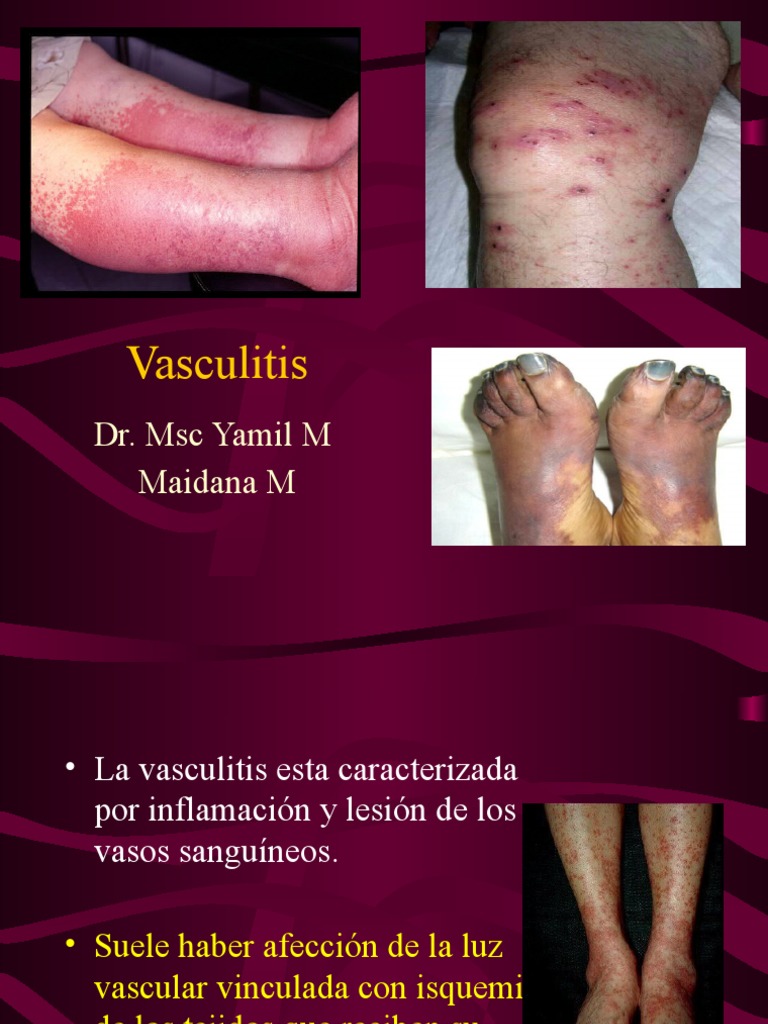 Vasculitis | PDF | Inflamación | Medicina CLINICA