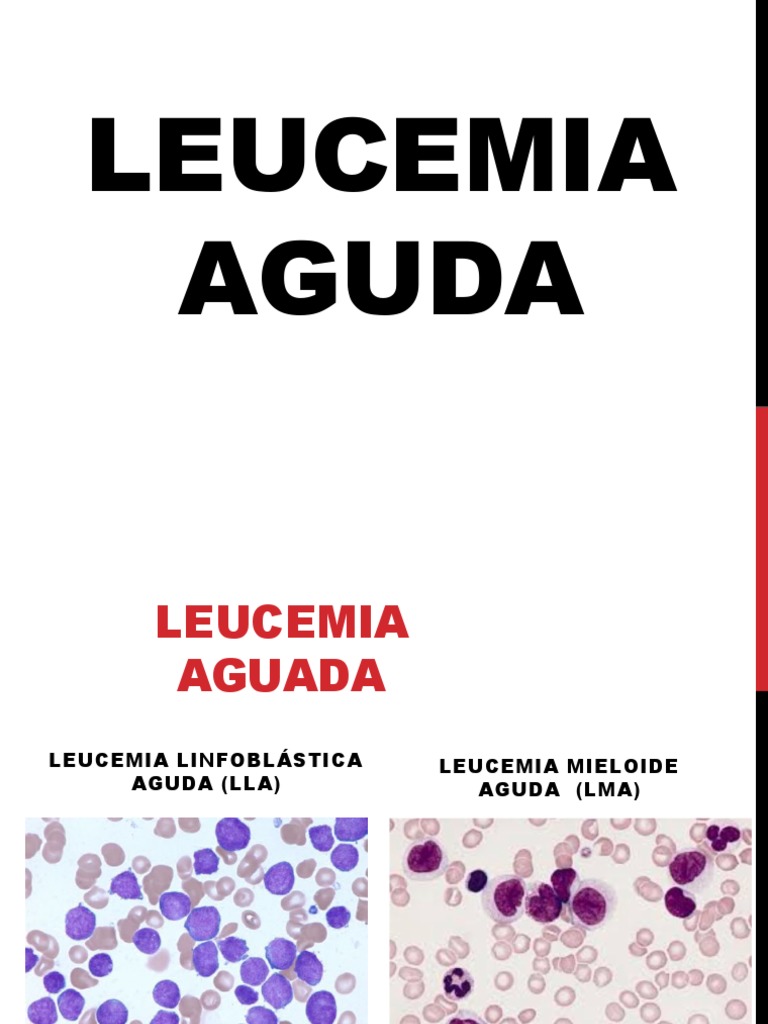 Leucemia Aguda | PDF | Leucemia | Especialidades Medicas