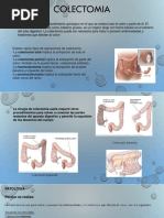 Sigmoidectomia Laparoscopica | PDF | Intestino grueso | Cirugía
