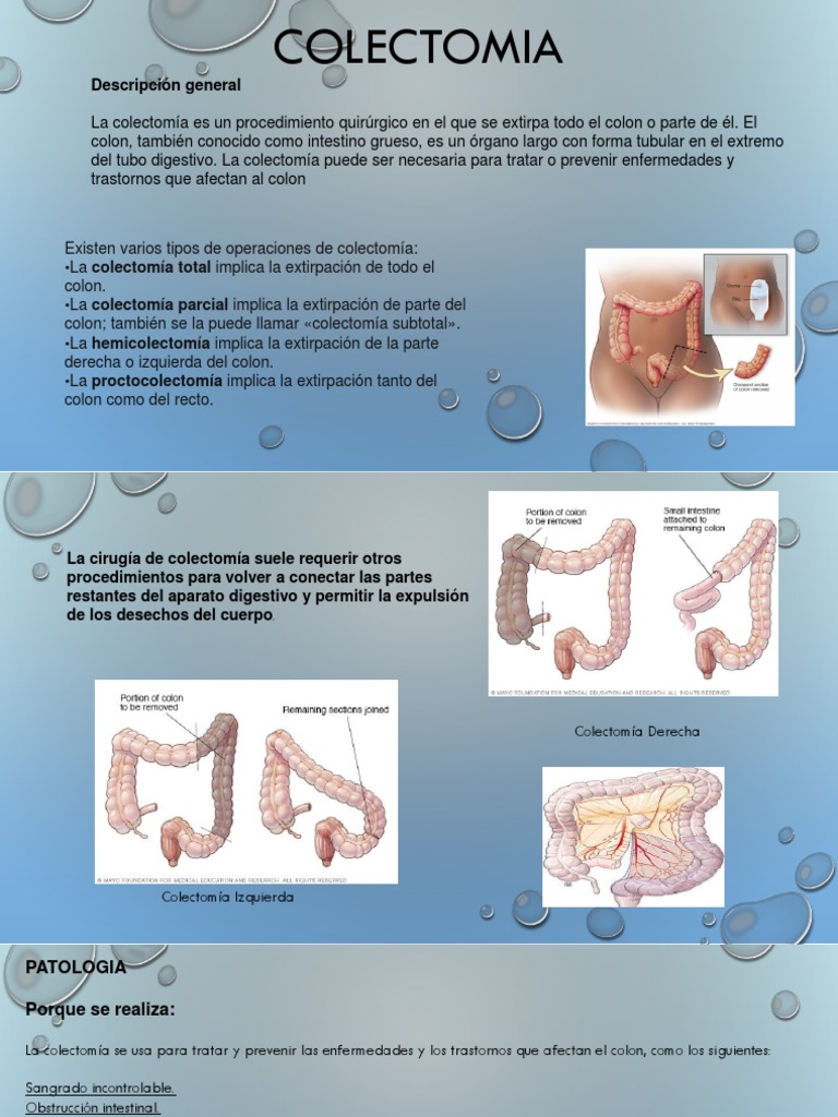 Tipos de Colectomías y Procedimientos | PDF | Intestino grueso | Cáncer ...