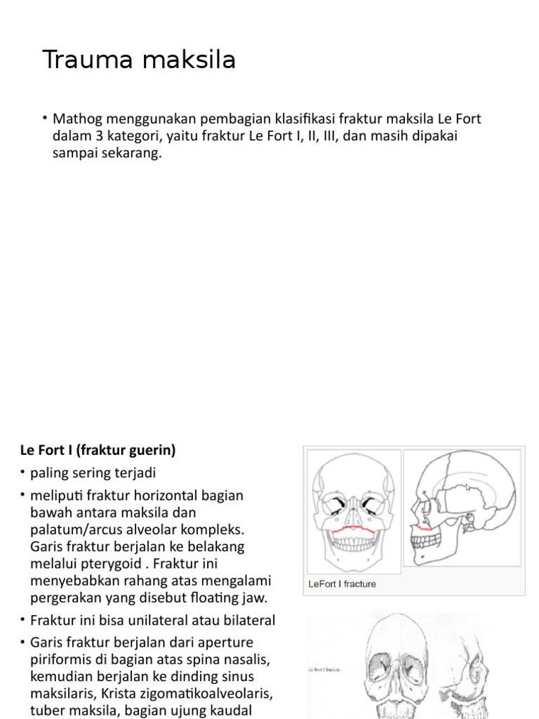 Fraktur Maksila | PDF