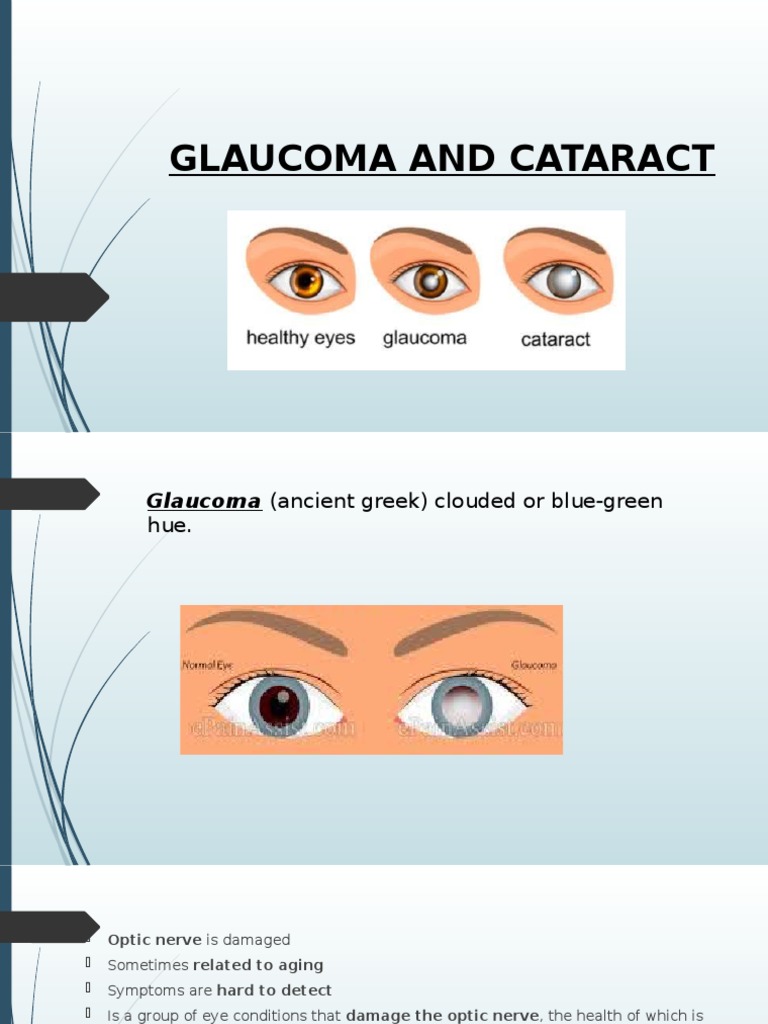 Glaucoma and Cataract Overview | PDF | Glaucoma | Cataract