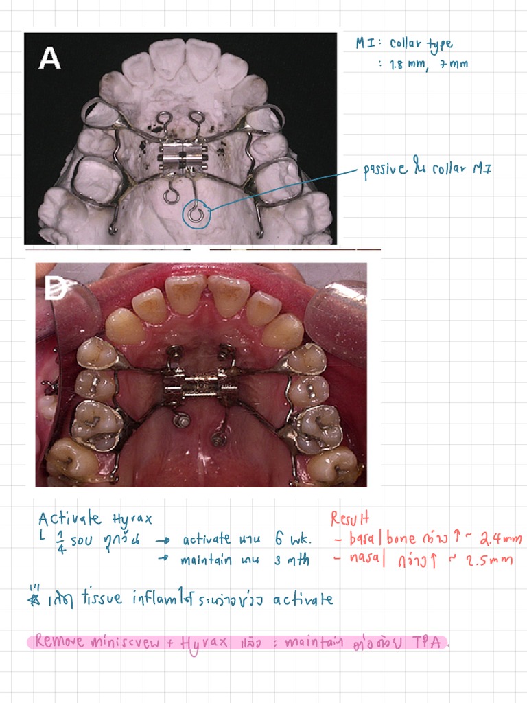 Ajodo Marpe | PDF | Orthodontics | Face