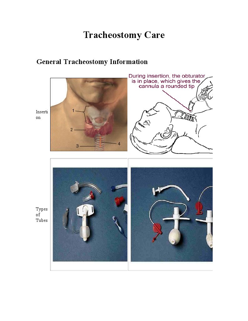 Tracheostomy Tube Suctioning