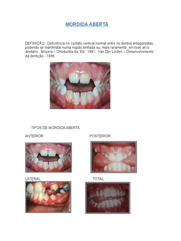 10 - Mordida Aberta | PDF | Dente | Língua