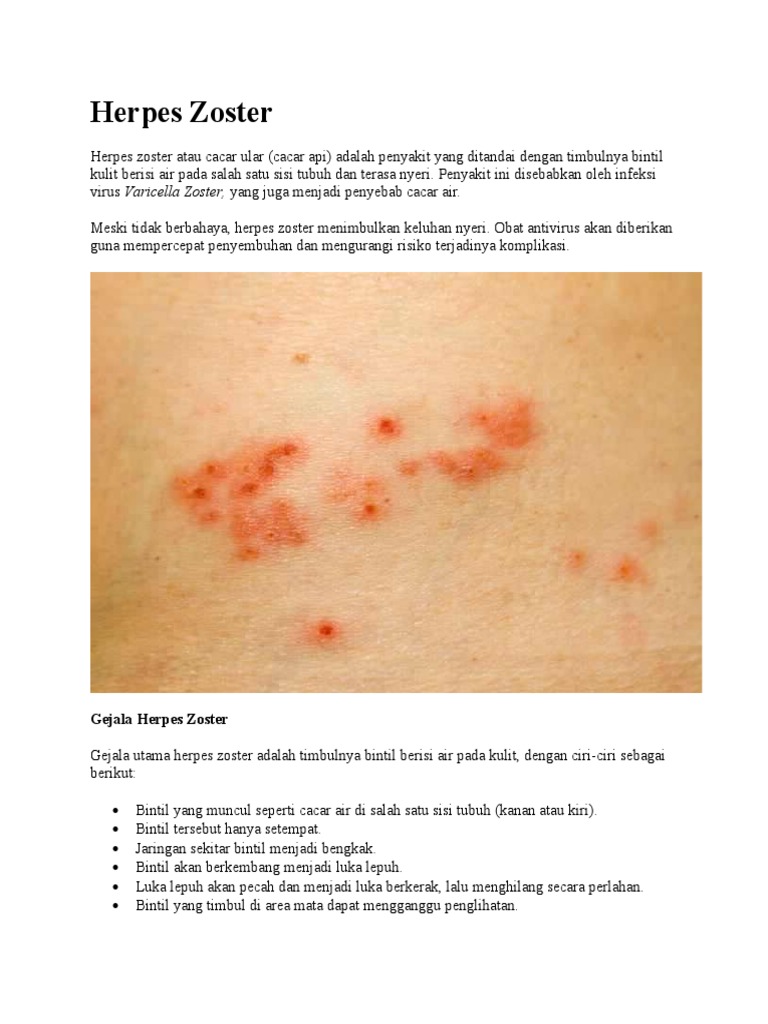 Varicella | PDF | Sains & Matematika