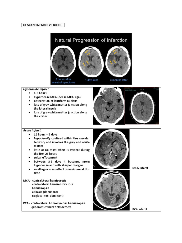 Bleed Vs Infarct Comparison | PDF | Nervous System | Neuroanatomy