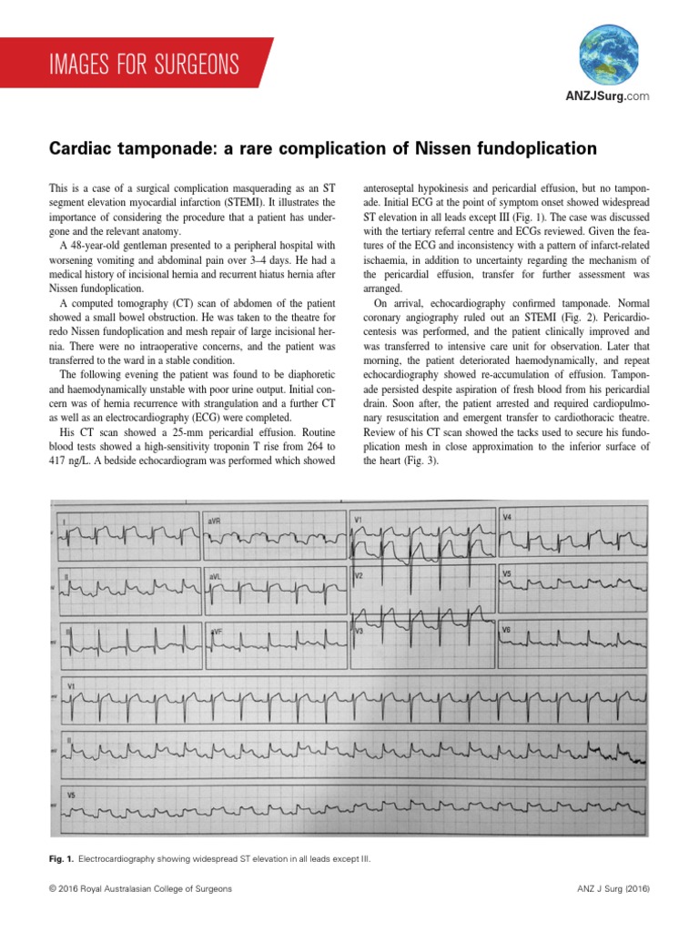Cardiac Tamponade A Rare Complication of Nissen Fundoplication | PDF ...