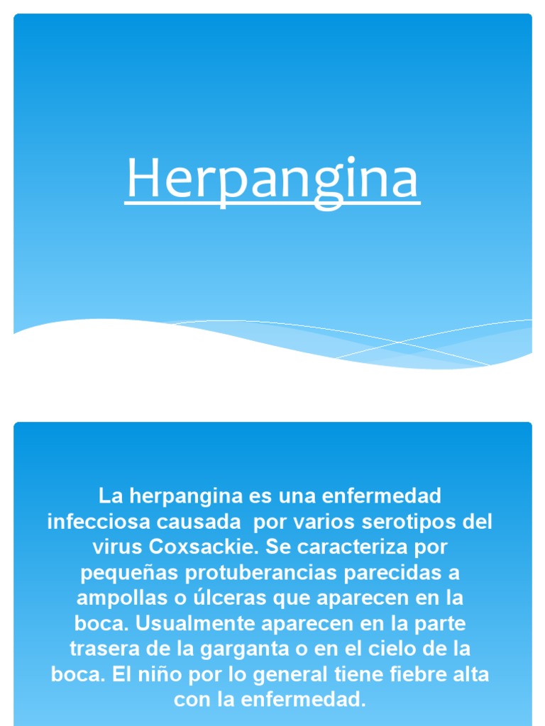 Herpangina | PDF