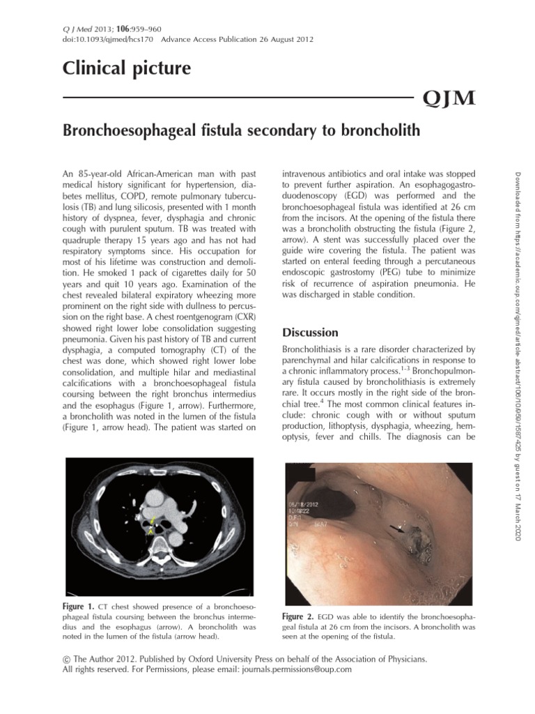 Bronchoesophageal Fistula Secondary To Broncholith PDF | PDF ...