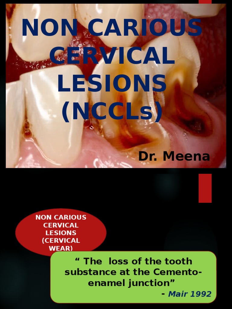 Understanding Non-Carious Cervical Lesions | PDF | Tooth Enamel | Dentistry
