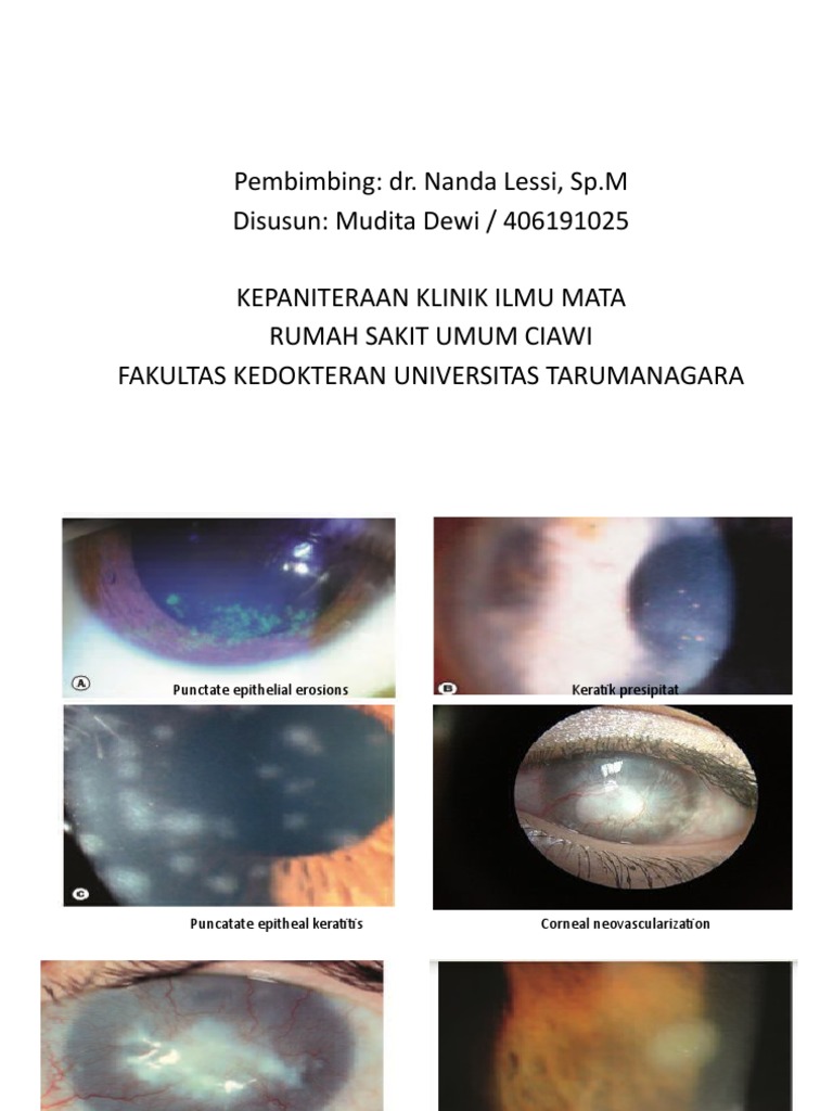 Corneal Sign | PDF