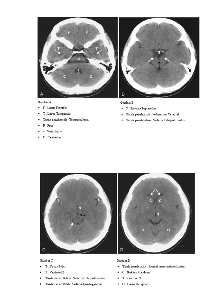 CT Kepala | PDF