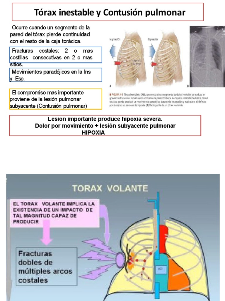 Tórax Inestable y Contusión Pulmonar | PDF
