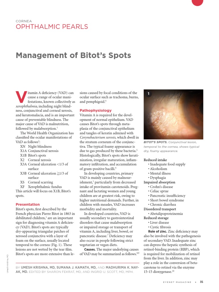 Management of Bitot Spot | PDF | Vitamin A | Medical Specialties