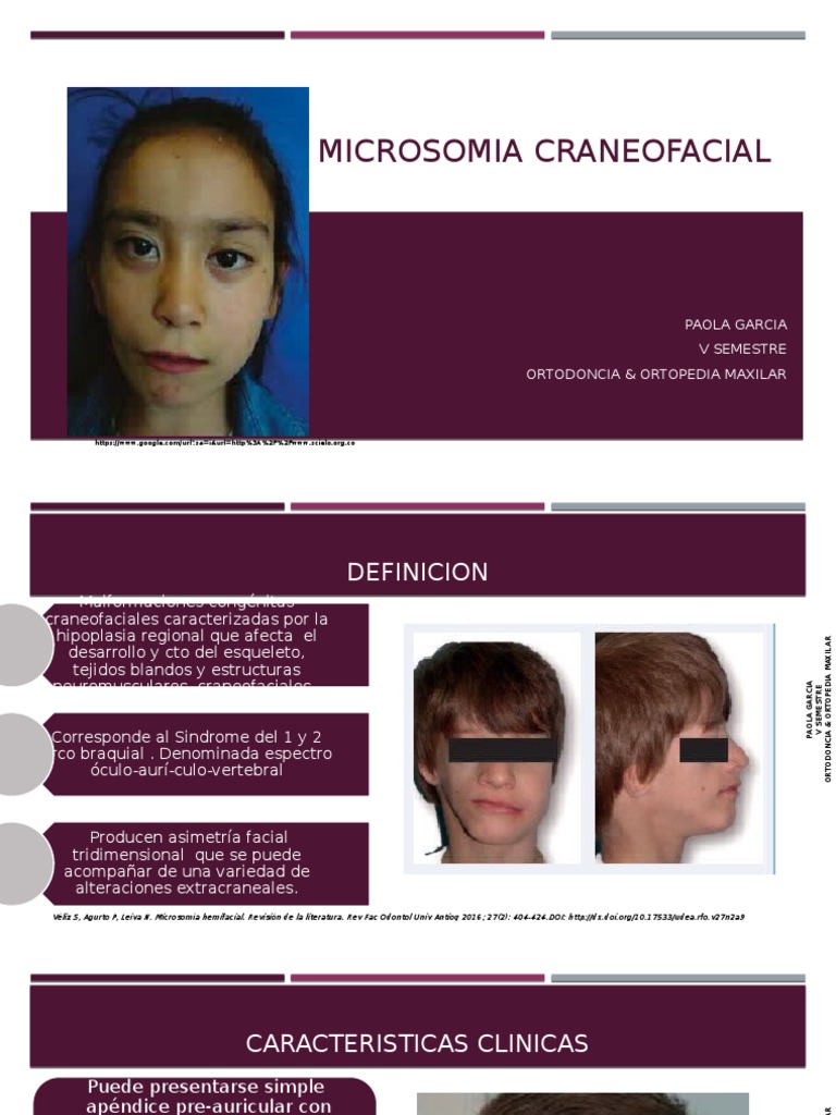 Microsomía Craneofacial: Características y Tratamiento | PDF ...