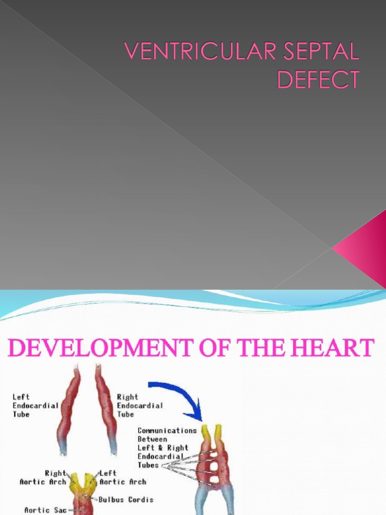 Ventricular Septal Defect | PDF | Ventricle (Heart) | Congenital Heart ...