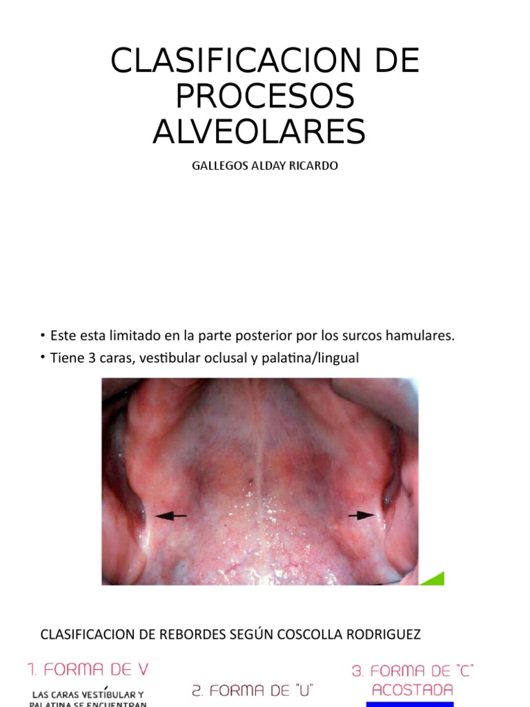 Clasificacion de Procesos Alveolares | PDF