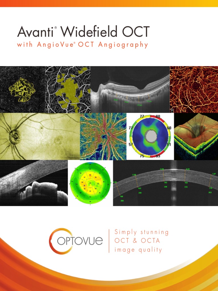 Optovue Avanti AngioVue Brochure - US | PDF | Retina | Cornea
