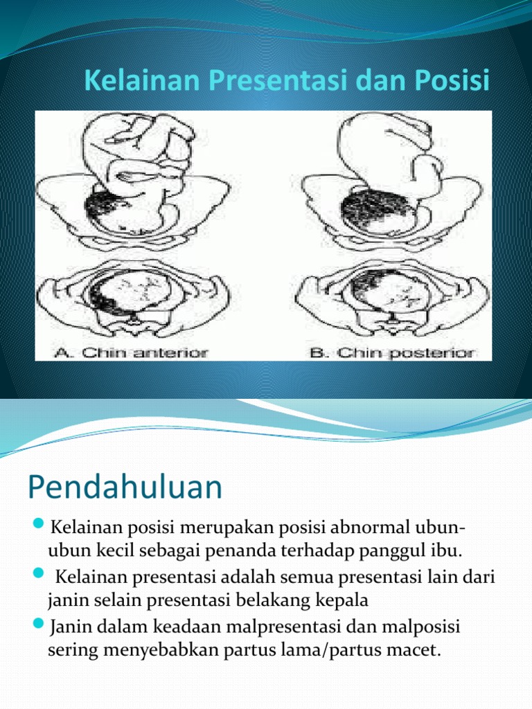 Kelainan Presentasi Janin dan Penanganan | PDF