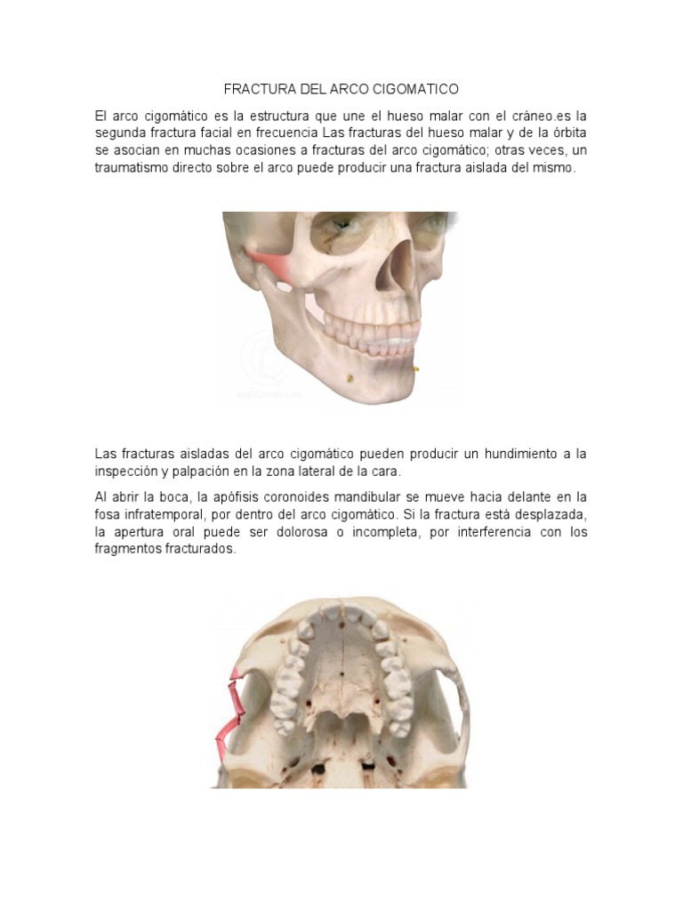 Fractura del Arco Cigomático: Diagnóstico y Tratamiento | PDF | Ct Scan ...