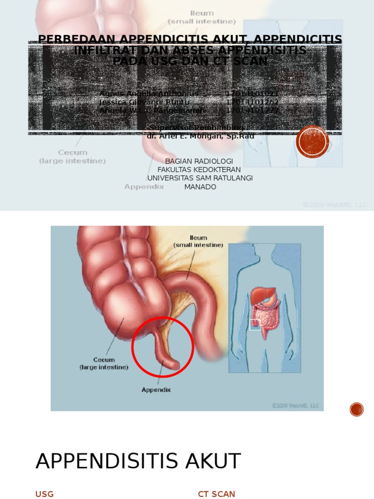 Perbedaan Appendicitis Akut, Appendicitis Infiltrat Dan Abses | PDF