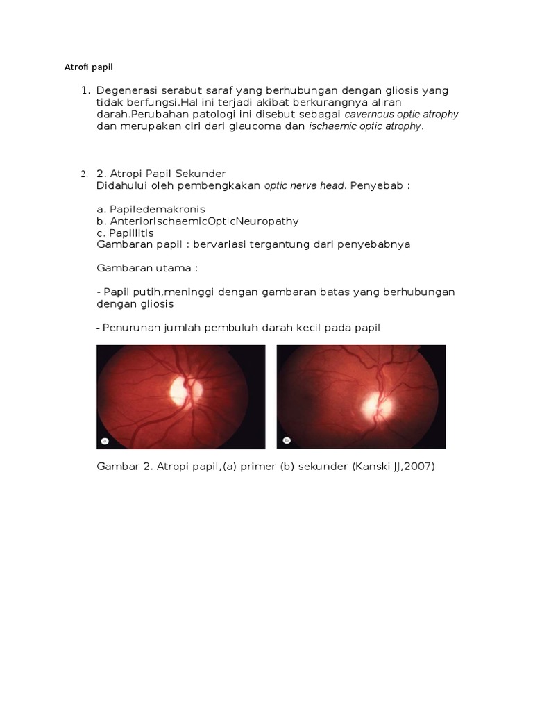 Atrofi Papil: Penyebab dan Gambaran Klinis | PDF
