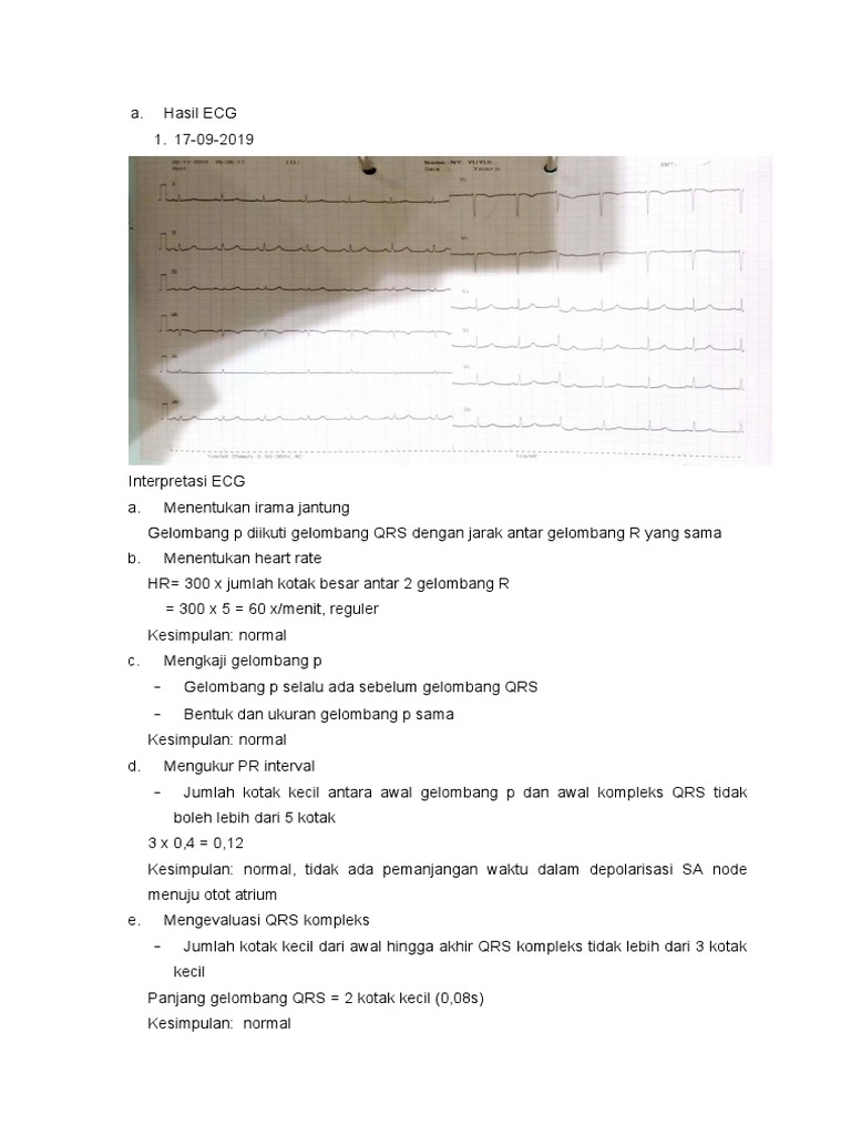 Contoh Interpretasi EKG | PDF