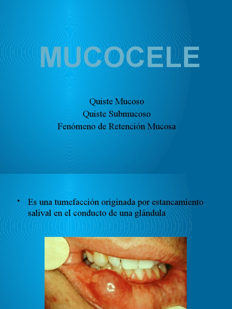 MUCOCELE | PDF | Boca | Gastroenterología