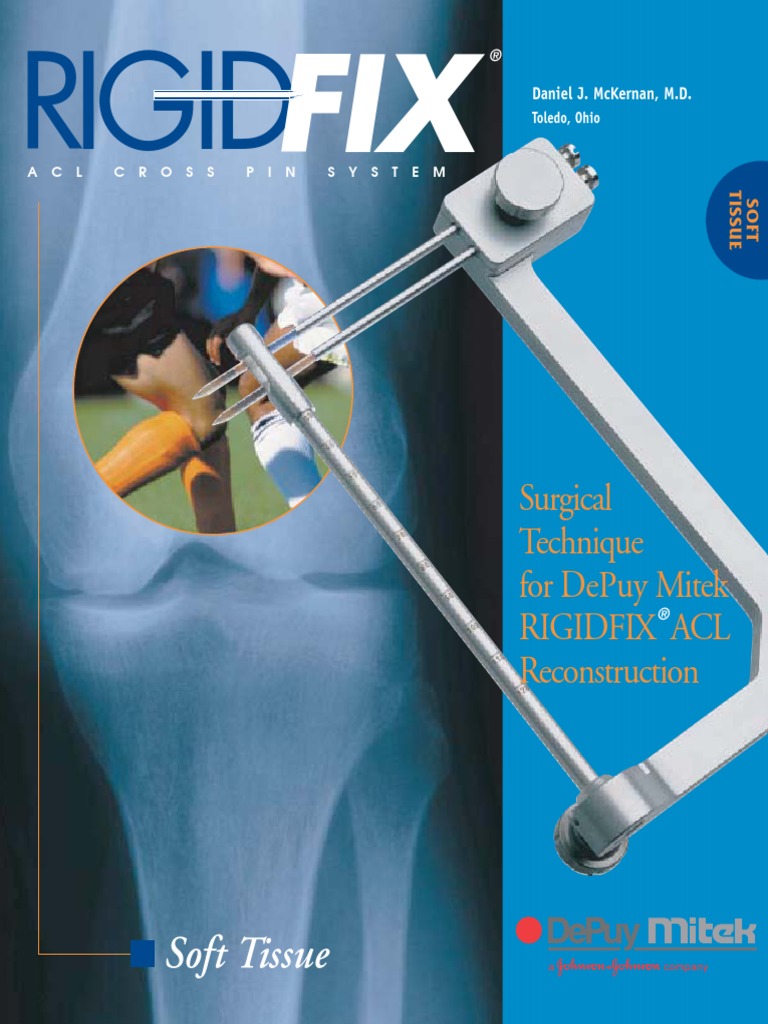RIGIDfix SoftTissue McKernan | PDF | Musculoskeletal System | Clinical ...