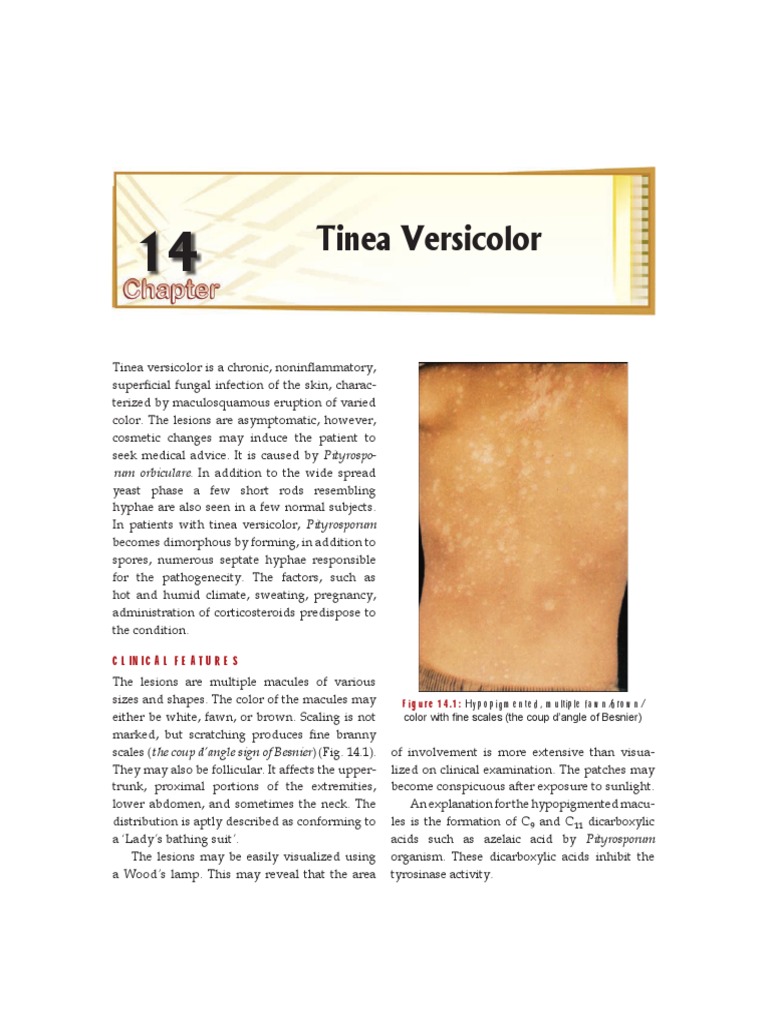 Understanding Tinea Versicolor: Causes, Clinical Features, Diagnosis ...