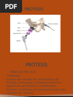 Protesis de Thompson Espanol SCECLE | PDF | Cirugía | Medicina CLINICA