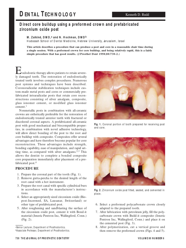 Ental Echnology: Direct Core Buildup Using A Preformed Crown and ...