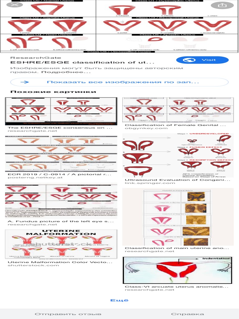 u4 eshre - Поиск в Google | PDF | Congenital Disorder | Uterus
