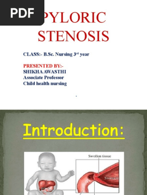 Pyloric Stenosis Olive Shaped Mass