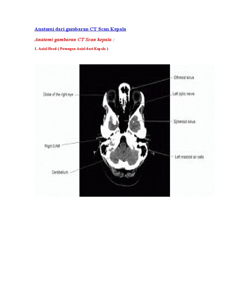 Anatomi CT Scan Kepala Potongan Axial Coronal Sagital | PDF