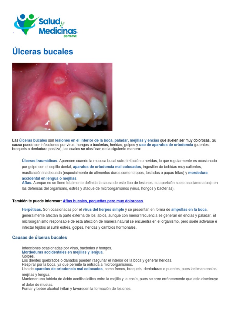Ulceras Bucales | PDF | Herpes Simple | Infección